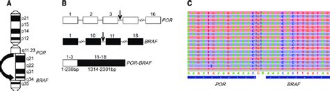 Por Braf Fusion A Scheme Of Chromosome 7 With A Paracentric Inversion