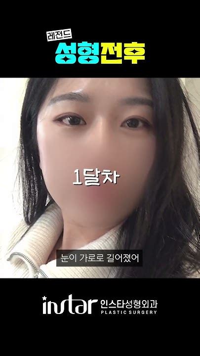 짝눈 쌍꺼풀 풀림 뭐든 해결해 주는 인스타성형외과 쌍수 쌍꺼풀수술 짝눈교정 짝눈 뒤트임 밑트임 뒤밑트임 쌍꺼풀수술후기 눈매교정 Youtube