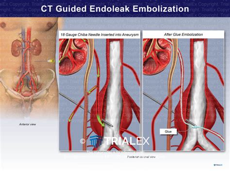 Ct Guided Endoleak Embolization Trialquest Inc