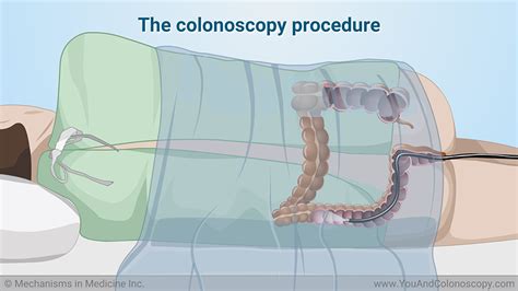 Slide Show What Happens During And After A Colonoscopy