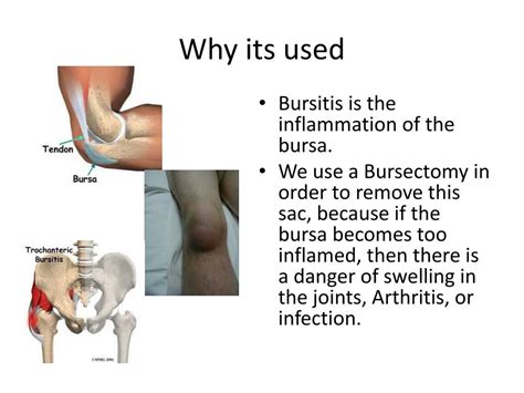 Ppt Bursectomy Powerpoint Presentation Free Download Id 2322245