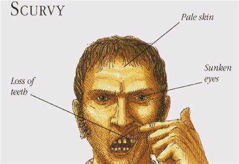 Scurvy By The End Death Is A Mercy Atlas Obscura