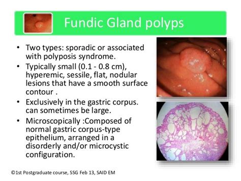 Management Of Gastric Polyps