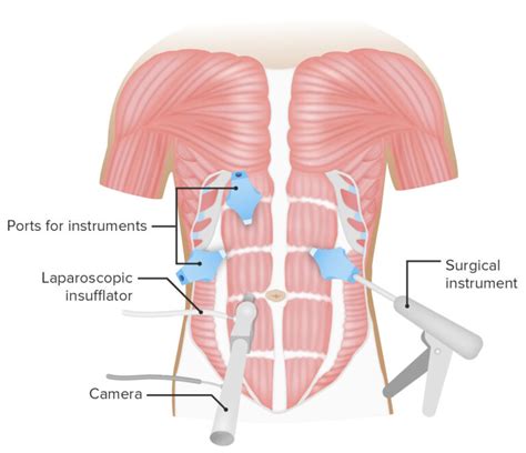 Laparotomy And Laparoscopy Concise Medical Knowledge