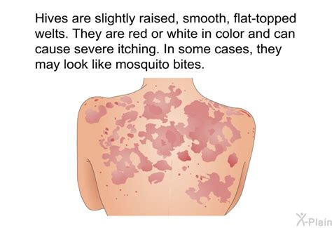 Hives And Angioedema