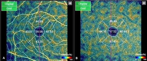 A Superficial Capillary Plexus Vascular Density Centered 1 Mm