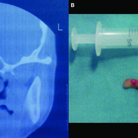 Patient 1 A Coronal Ct Shows The Polyp In The Left Sphenoid Sinus B