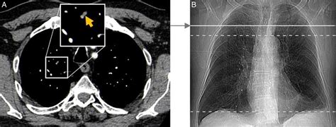 Example Of A Case With An Isolated Embolus Outside The Reduced Range Download Scientific