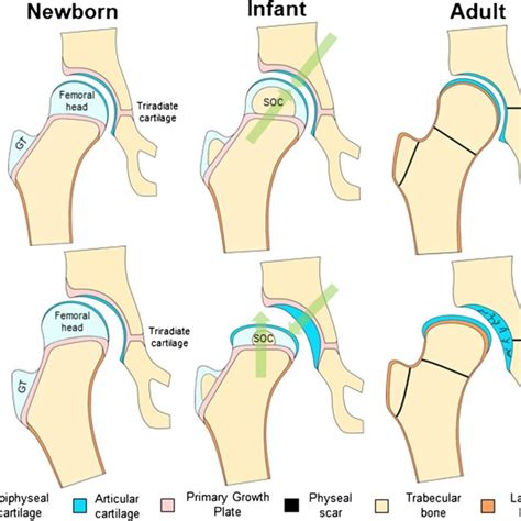 Acetabular Index On Radiography Anteroposterior Radiography In An Download Scientific Diagram