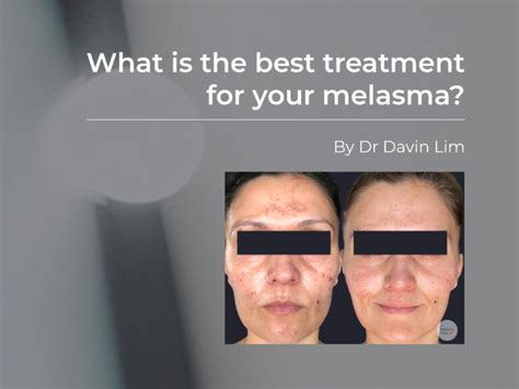 Best Melasma Treatments In Brisbane Melasma Removal Cutis Clinic