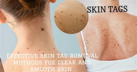 Unmasking The Truth About Skin Tags What You Need To Know And How To