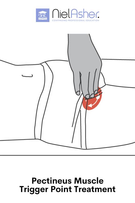 Pectineus Muscle Trigger Point Treatment Artofit