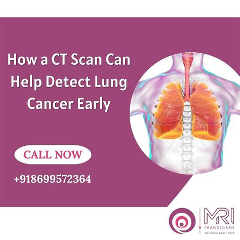 How A Ct Scan Can Help Detect Lung Cancer Early