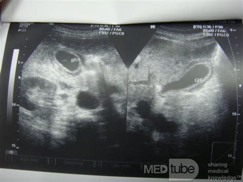 Colecistitis Aguda Alitiásica En Ultrasonido • Imagen • Medtubees