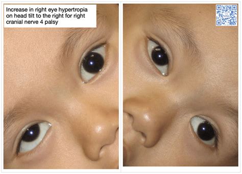 Cranial Nerve 4 Palsy
