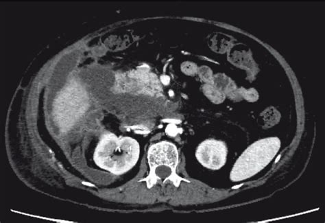 Acute Cholangitis After Over The Scope Clip Placement Involving The Duodenal Papilla That Was