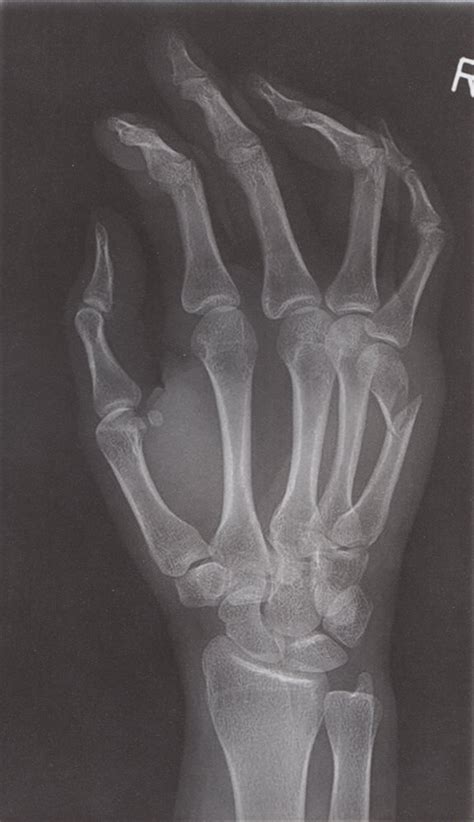 Metacarpal Head Fracture