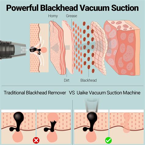 Blackhead Diagram