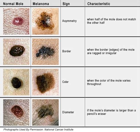 Abcde Of Melanoma Medizzy