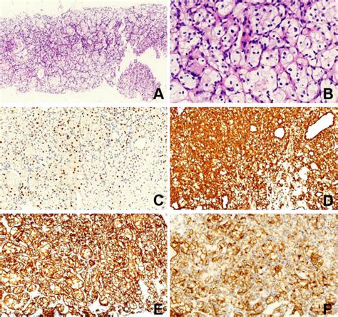 Renal Clear Cell Carcinoma Metastasis To The Right Arm A B