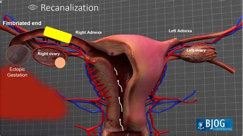Recanalization Youtube