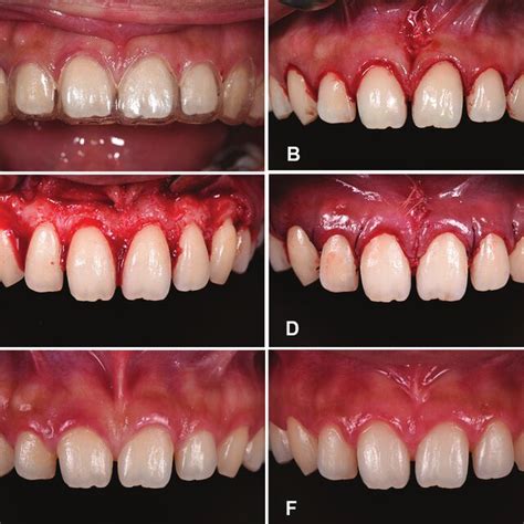 Periodontal Surgery A Periodontal Stent Try In B Frenectomy And