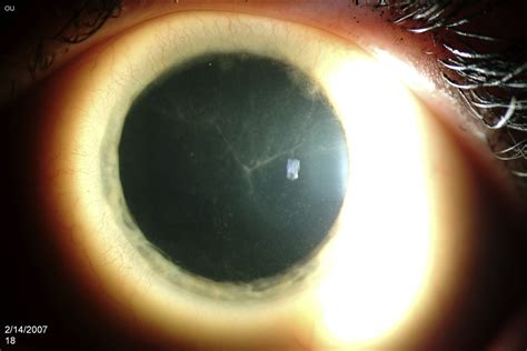 Dendritiform Keratopathy Associated With Exposure To Polyquarternium 1