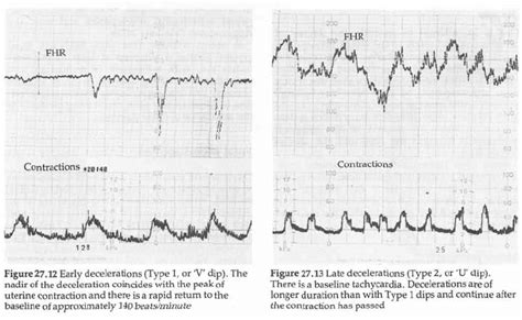Early And Late Decelerations In Traditional British Practice Download Scientific Diagram