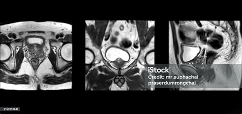 Mri Of The Prostate Gland Reveals Focal Abnormal Si Lesion At Left Pzpl