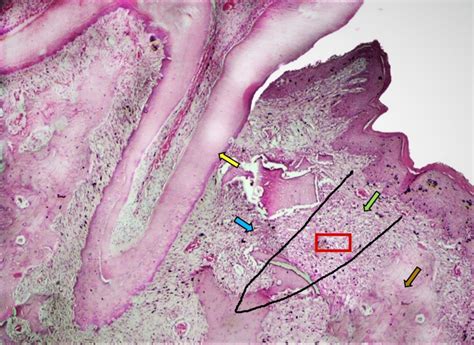 Photomicrograph Of Extracted Tooth Socket Of Group A Control 7 Days