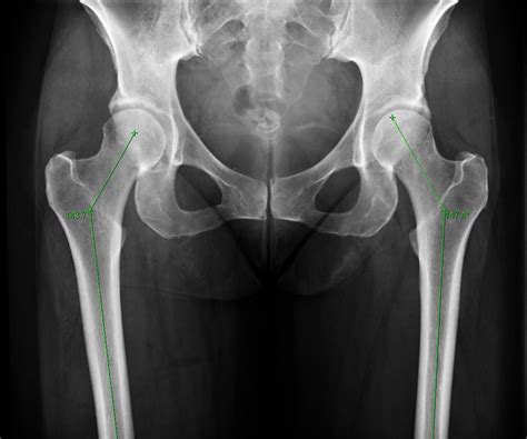What Does A Healthy Hip X Ray Look Like At Noah Noriega Blog