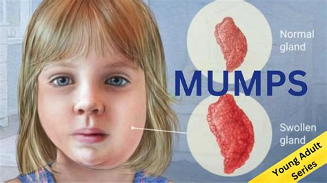 Mini Course Series Mumps Learning4you