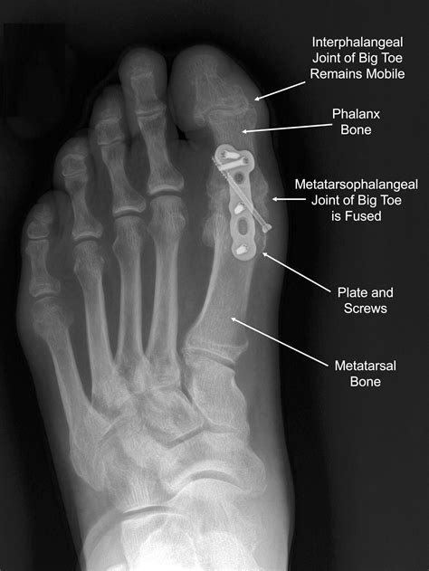Distal Interphalangeal Joint Fusion At John Froehlich Blog