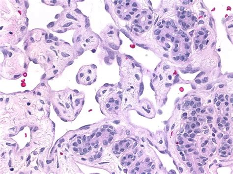 Angiosarcoma Of Breast Low Grade