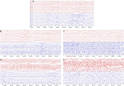A Interictal EEG In Bipolar Longitudinal Montage Right Over Left Download Scientific Diagram