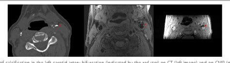 Figure 1 From Comparison Of Ct And Cmr For Detection And Quantification Of Carotid Artery