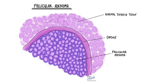 Follicular Adenoma In The Thyroid Gland Mypathologyreport Ca