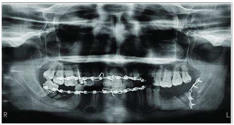 Orthopantomography Of A Case With A Double Fracture Of The Mandible Download Scientific