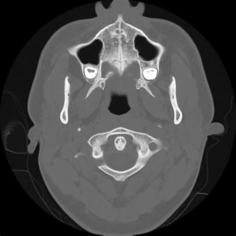 Normal Temporal Bone Ct With Annotated Images Radiopaedia 84293 99584 Axial Non Contrast Nc