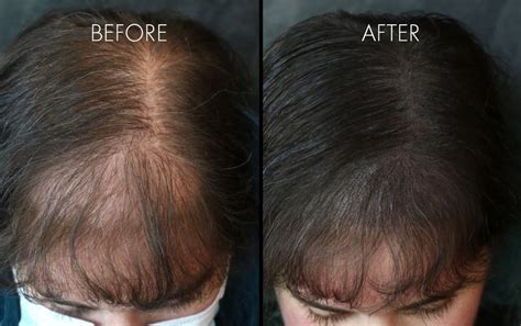 Everything You Need To Know About Scalp Micropigmentation Feel Beauty Recently