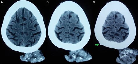 Flecked Calcifications In Scalp Tumors Two Cases Of Giant Ulcerated Trichilemmal Cysts