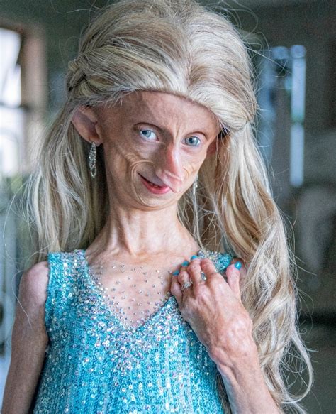Progeria Life Expectancy