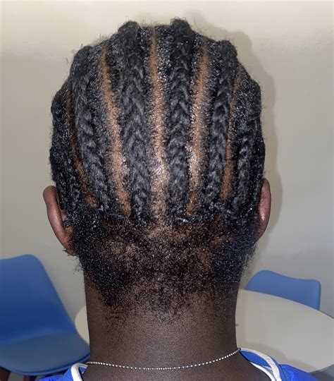 Help With My Scalp Folliculitis R Folliculitis