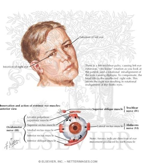 Trochlear Nerve Cn Iv Trochlear Nerve Cn Iv