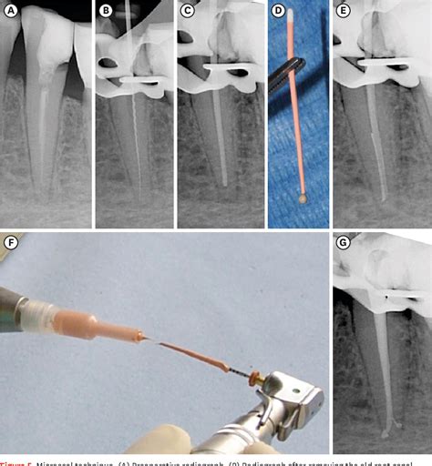 Figure 5 From The Fate Of Overfilling In Root Canal Treatments With