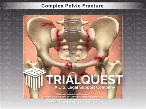 Complex Pelvic Fracture Trialquest Inc