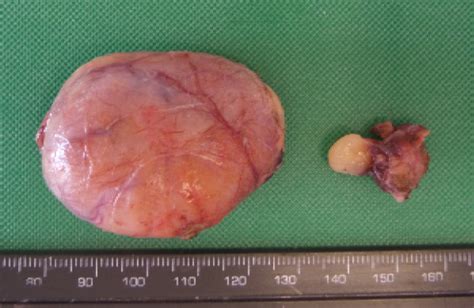 Parathyroid Adenoma Radiology Reference Article