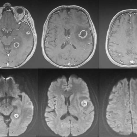 Brain Magnetic Resonance Imaging Mri Scan Showing Multiple Download Scientific Diagram