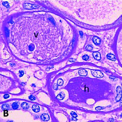 Tubulointerstitial Nephritis Including Tubular Atrophy Interstitial