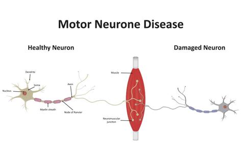 Nursing Care Of Motor Neurone Disease Mnd Ausmed